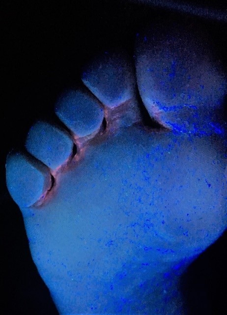 Picor en los pies. ¿Qué debo hacer? Infección interdigital por Eritrasma