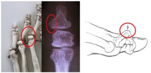 Heloma plantar, ¿qué es y cómo se trata?
