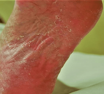 Afecciones de la piel por hongos: Tinea pedis.